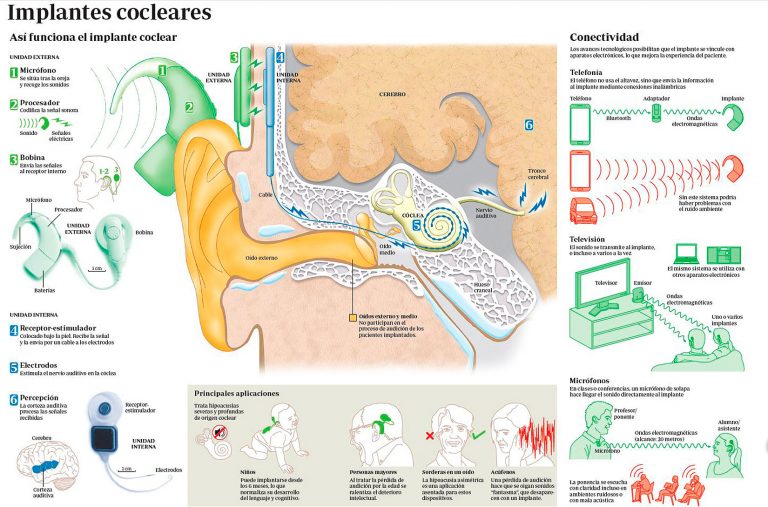Así funciona el implante coclear - INVDES