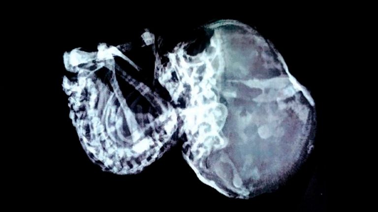 Descubrieron feto muerto en el estómago de un niño de 15 años - INVDES