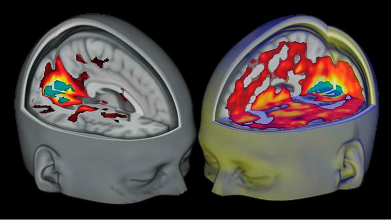Descubren los efectos del LSD en el cerebro gracias al modelado computacional - INVDES