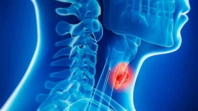 El tabaco es el responsable del 95% de los tumores de laringe - INVDES